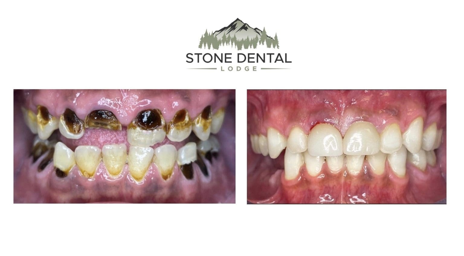 Before & After Photos | Stone Dental Lodge